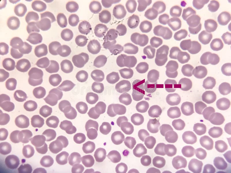 Microscopic View of Hematological Stained Slide Leucopenia Stock Image ...