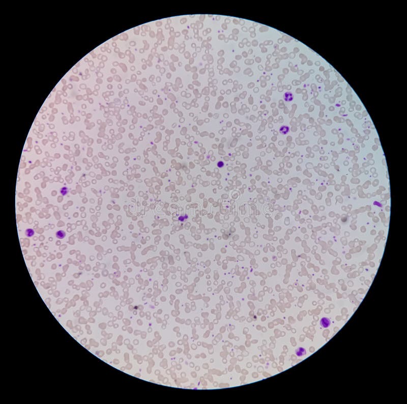 Microscopic View of Hematology Stained Slide in Laboratory. Stock Image ...