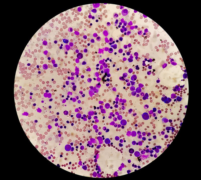 Microscopic View of Blood Showing Bone Marrow Cancer Stock Photo ...