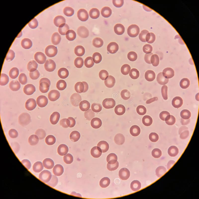 Microscopic View of Red Blood Cells Under a Microscope, Likely for ...