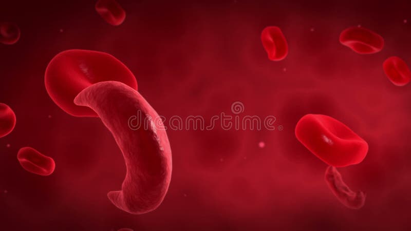 Microscopic Visualization of Sickle Cells Causing Anemia Disease Stock ...