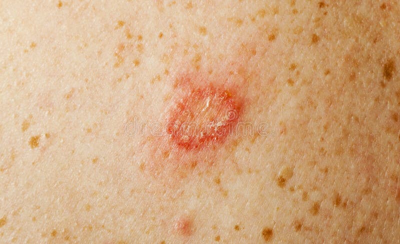 Fungus On Human Skin. Macro Stock Photo - Image of photography, dirty ...