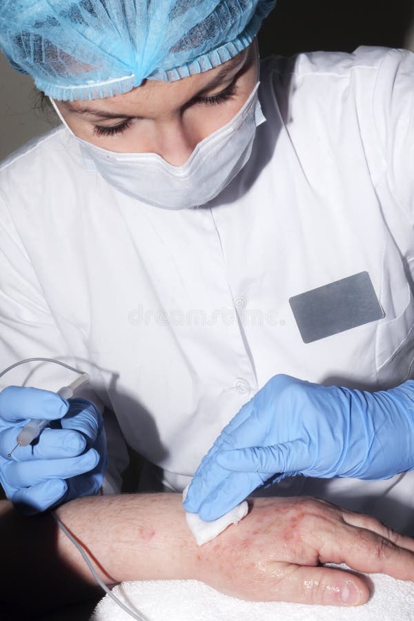 Microsurgery : Doctor Removes Skin Disease Stock Photo - Image of hand ...