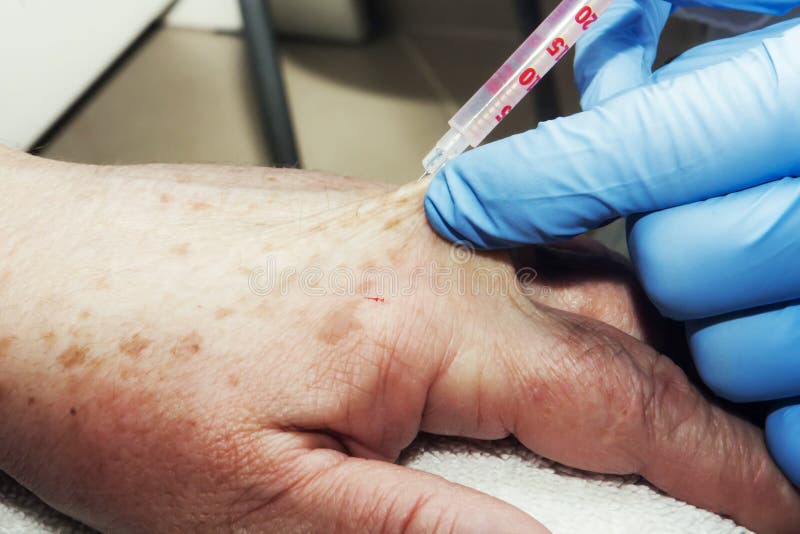 Microsurgery: Local Anesthesia on the Hand Stock Photo - Image of ...