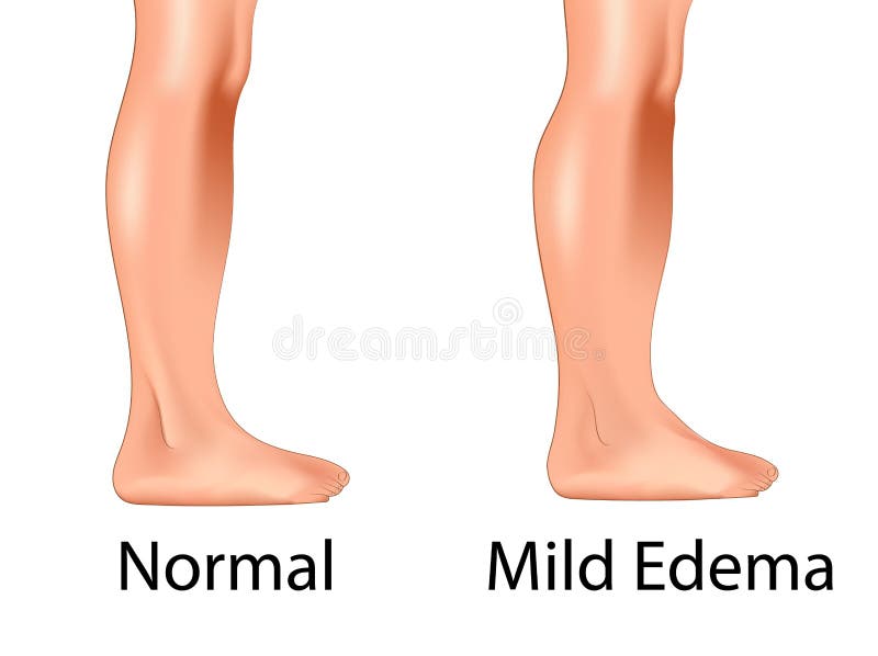 Oedeem Gezwollen Hand- of Armlymfeziekte Vector Illustratie ...