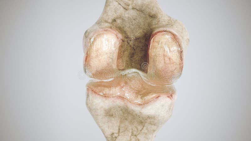 Osteoarthritis of the Knee in Four Stages - High Degree of Detail - 3D ...