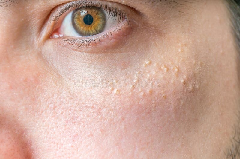 Milia (Milium) - Pimples Around Eye on Skin Stock Photo - Image of ...