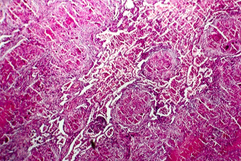 Miliary Tuberculosis, Light Micrograph Stock Image - Image of ...