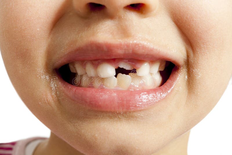 Milk teeth stock photo. Image of skin, growth, young - 24765668