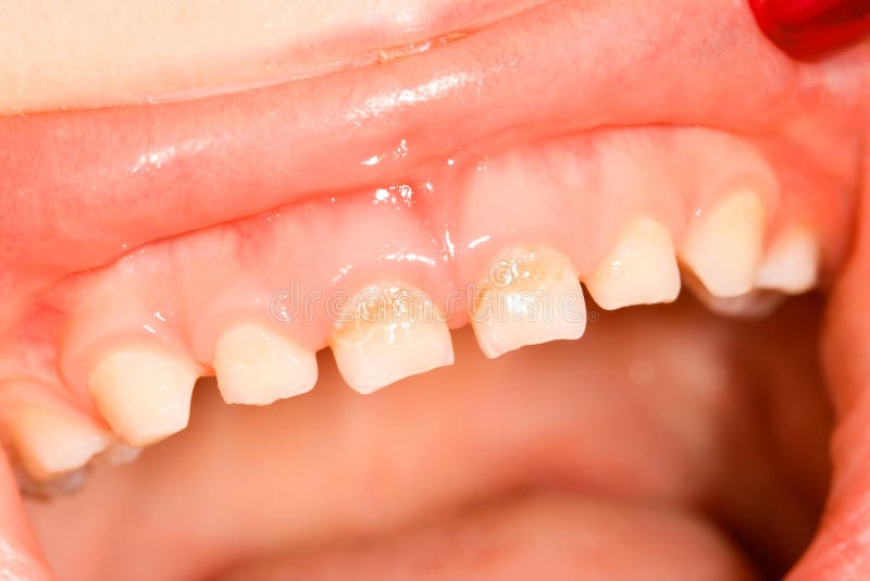 Milk teeth with decay stock image. Image of child, collection - 48417657