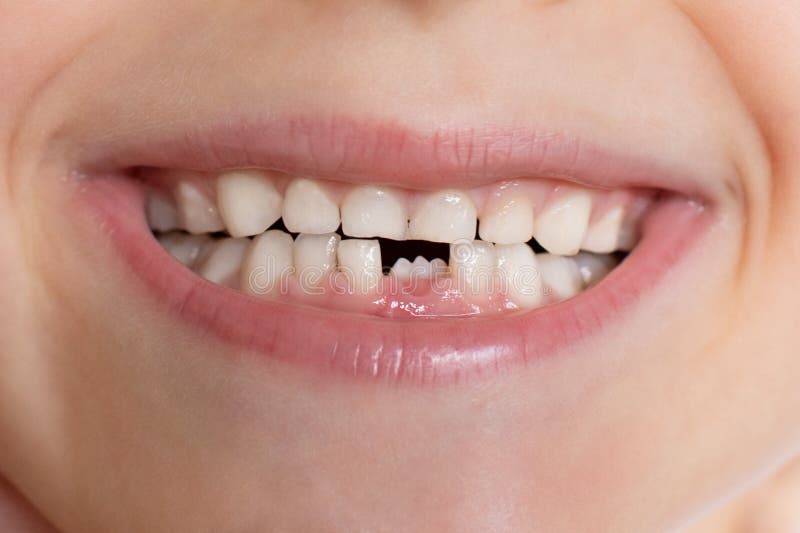 Milk Teeth and the First Molar Growing Stock Photo - Image of milk ...