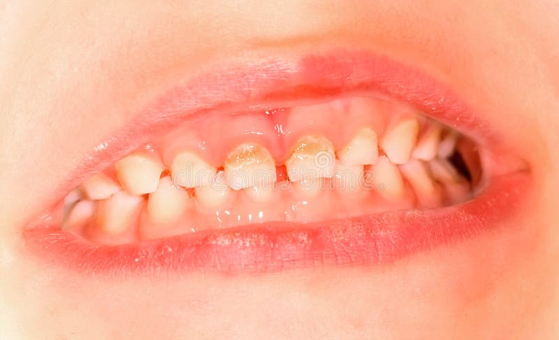 Milk tooth stock photo. Image of teeth, healthy, examine - 28745486