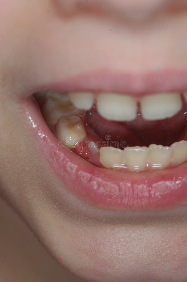 The Boy S Milk Tooth Fell Out. a Satisfied Child Holds a Tooth in His ...
