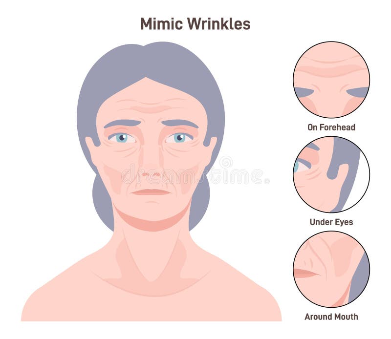 Mimic Wrinkles. Age-related Skin Changes Stock Illustration ...
