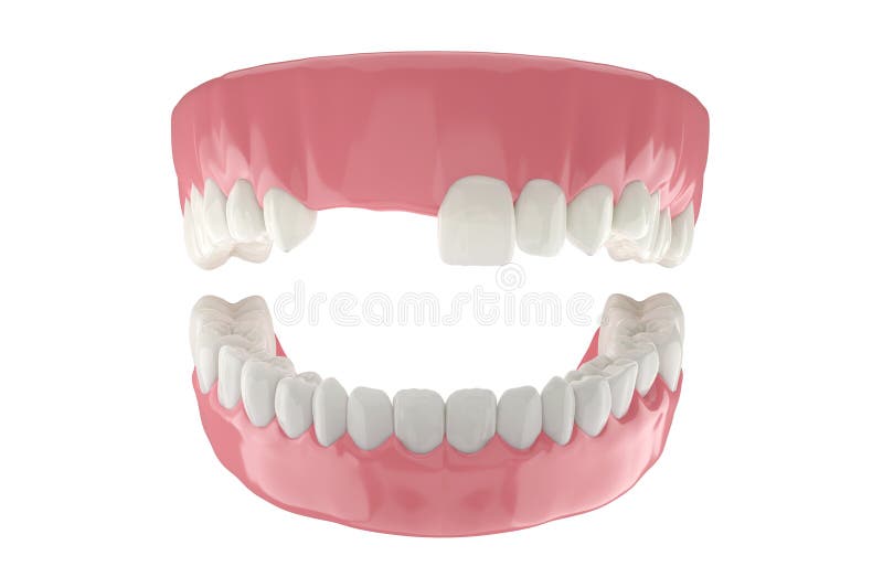 Missing Front Teeth with Full Tooth and Gums Stock Illustration ...