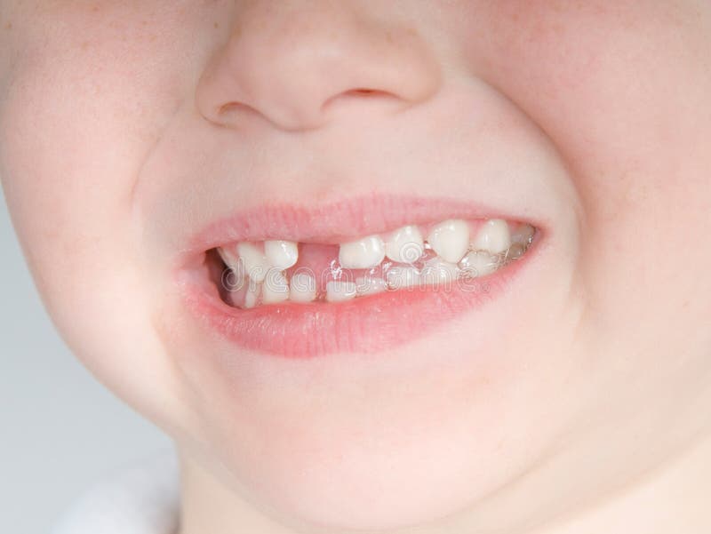 Missing front tooth stock photo. Image of cute, child - 13120346