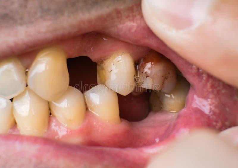 Missing Teeth and Dental Problems in a Caucasian Man Stock Photo ...