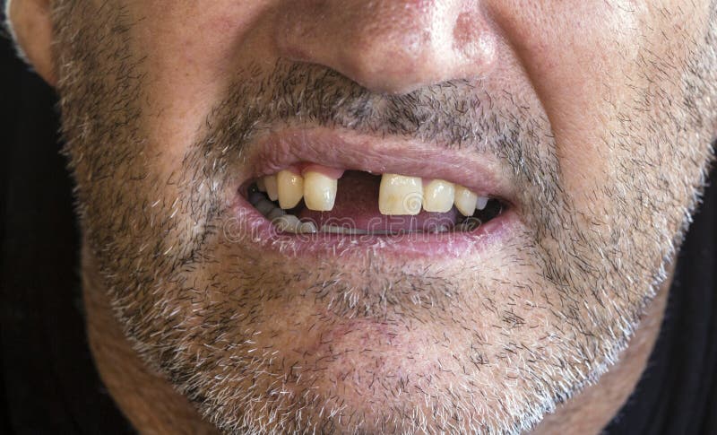 462 Man Missing Tooth Stock Photos - Free & Royalty-Free Stock Photos ...