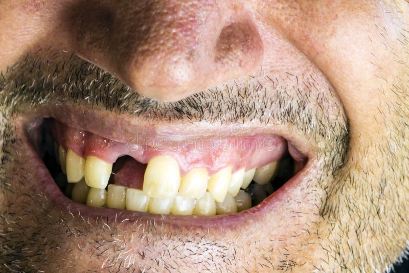 Missing Tooth stock photo. Image of healthcare, male - 39615088