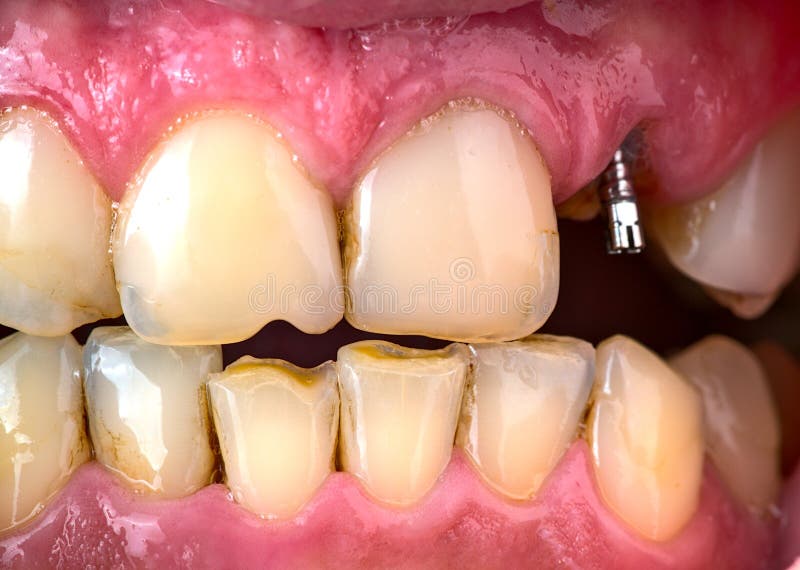 A Missing Tooth and a Stent Screwed into Its Place in Closeup. Stock ...