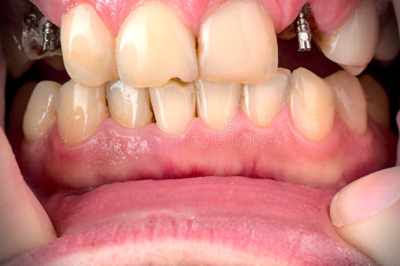 124 Smoker Teeth Stock Photos - Free & Royalty-Free Stock Photos from ...