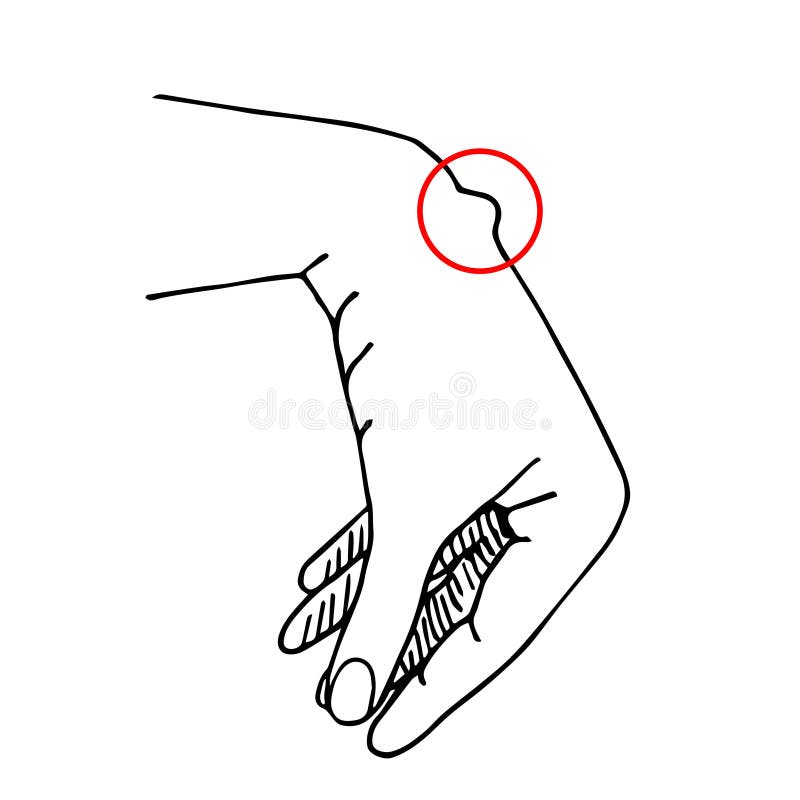 Cyst Finger Stock Illustrations – 20 Cyst Finger Stock Illustrations ...