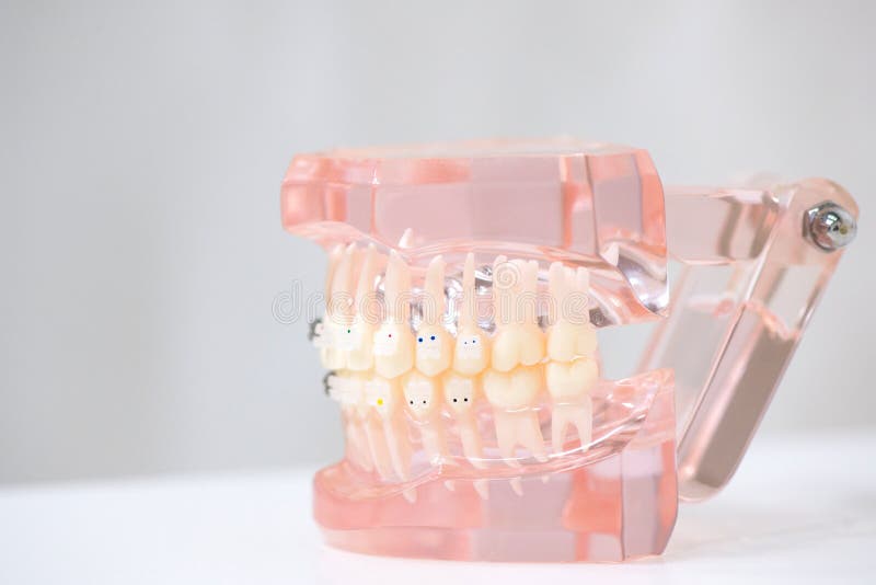 Mock Teeth with Braces. Demonstration Model of Teeth Editorial Image ...
