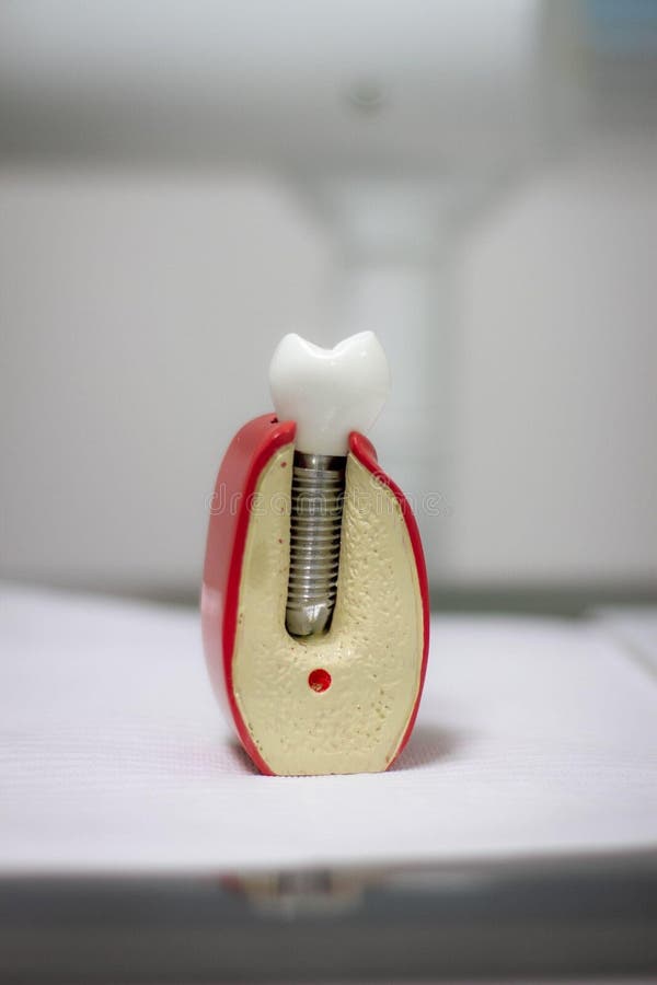 Model Demonstrating a Dental Implant Stock Image - Image of anatomy ...