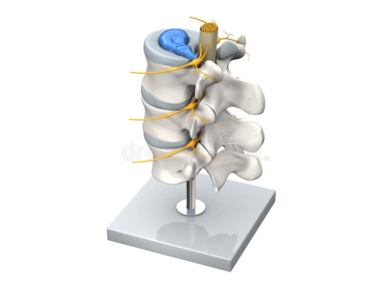 Model of a Herniated Disc of the Lumbar Spine. 3D Illustration Stock ...