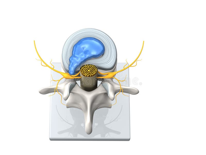 Model of a Herniated Disc of the Lumbar Spine, Stenosis, Slipped Disc ...
