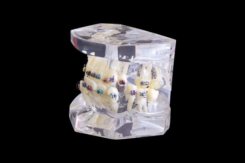 Model of Human Jaw with Wire Braces Attacheg Isolated on Black ...