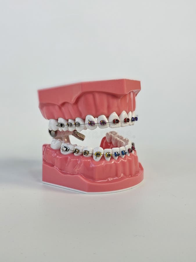 Model of Human Teeth with Braces Displayed on a White Background ...