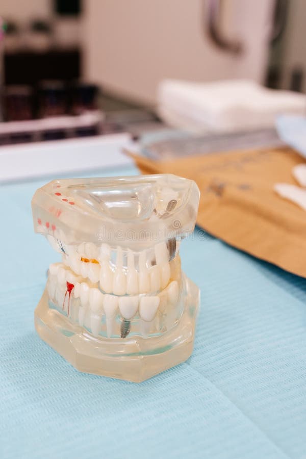 Model of Jaw and Teeth in Dentist S Office Stock Photo - Image of ...
