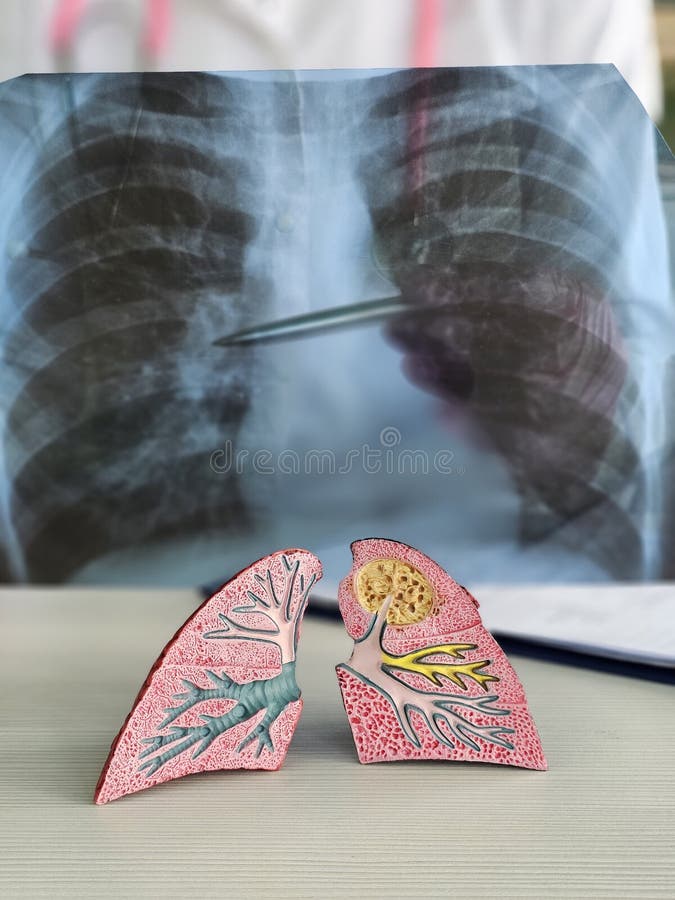 Model Lungs Displayed in Front of a Chest X-ray Highlighting ...
