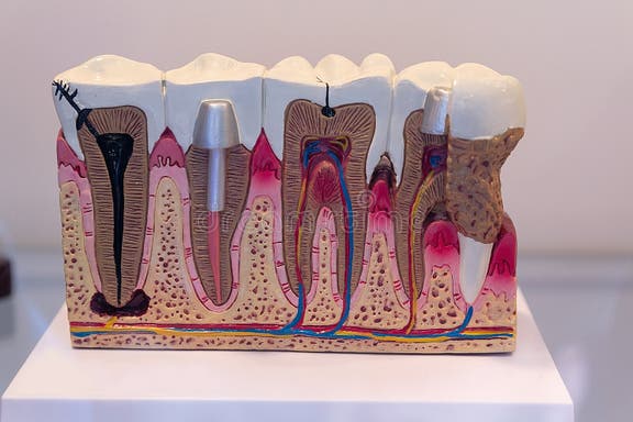 Model with Samples of Treatment and Prosthetics of Human Teeth Stock ...