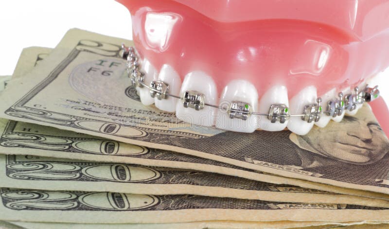 Model of Teeth with Braces and Money Stock Photo - Image of teeth ...