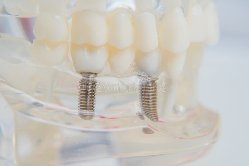 A Model of Teeth with Implants Lies on a Table Stock Image - Image of ...