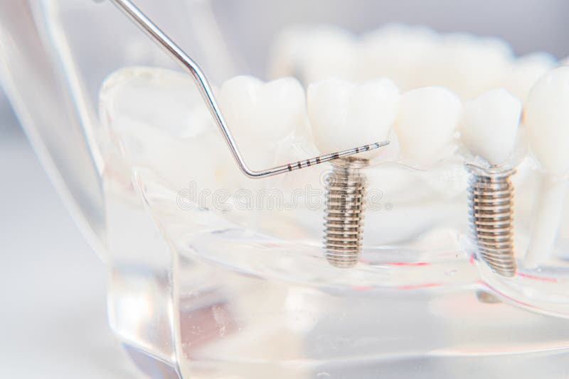 A Model of Teeth with Implants Lies on a Table Stock Photo - Image of ...