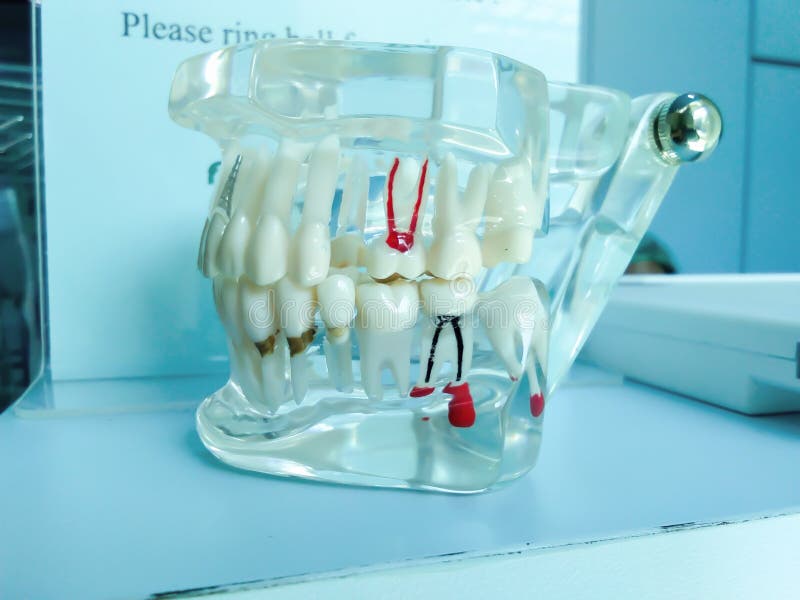 Model of Teeth Root Cure or Repair and Fill Teeth Stock Photo - Image ...