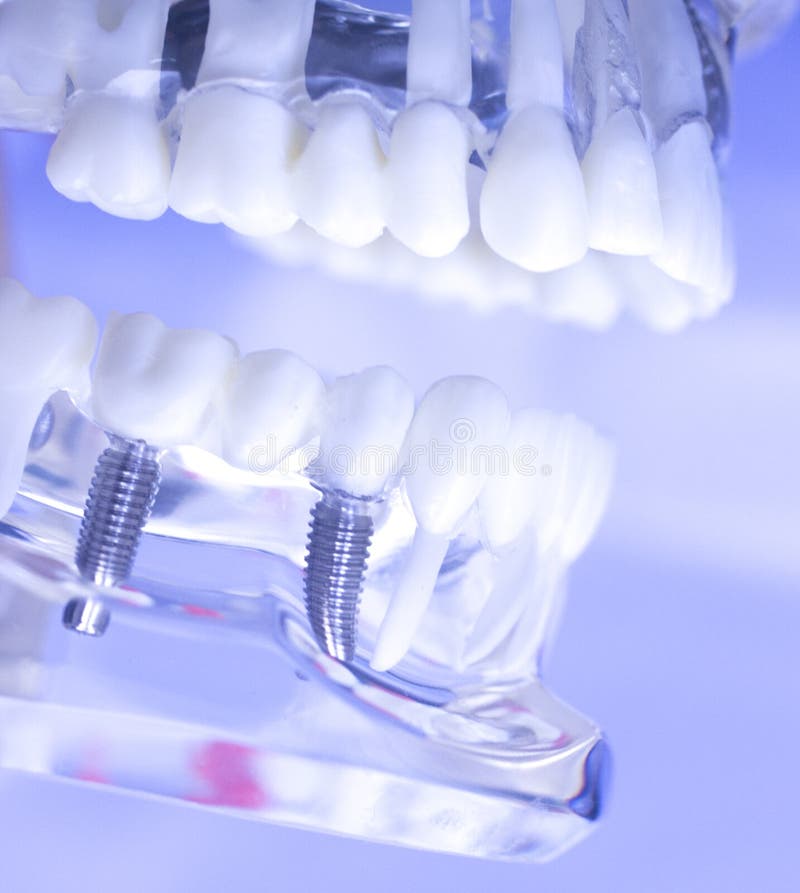 Modelo Dental De La Boca De Los Dientes Imagen de archivo - Imagen de ...