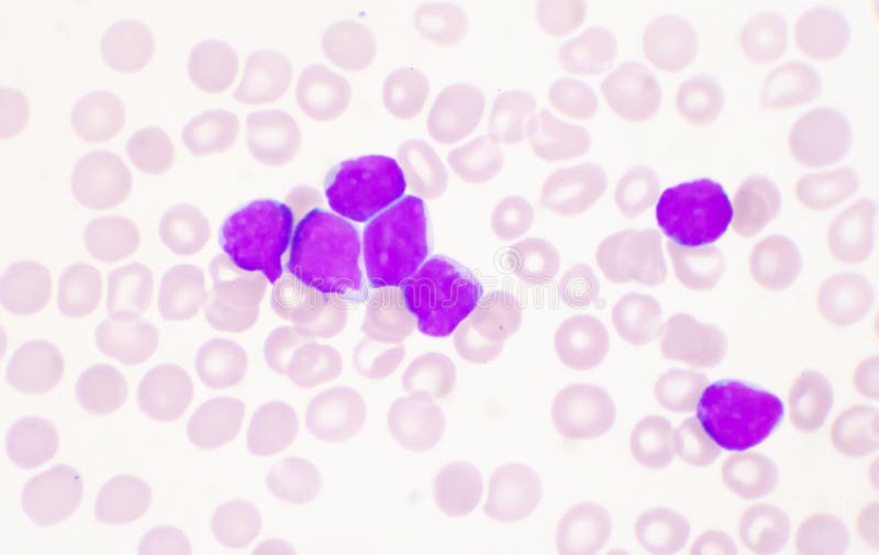 Moderate Blast Cell of White Blood Cells in Blood Smear Stock Photo ...