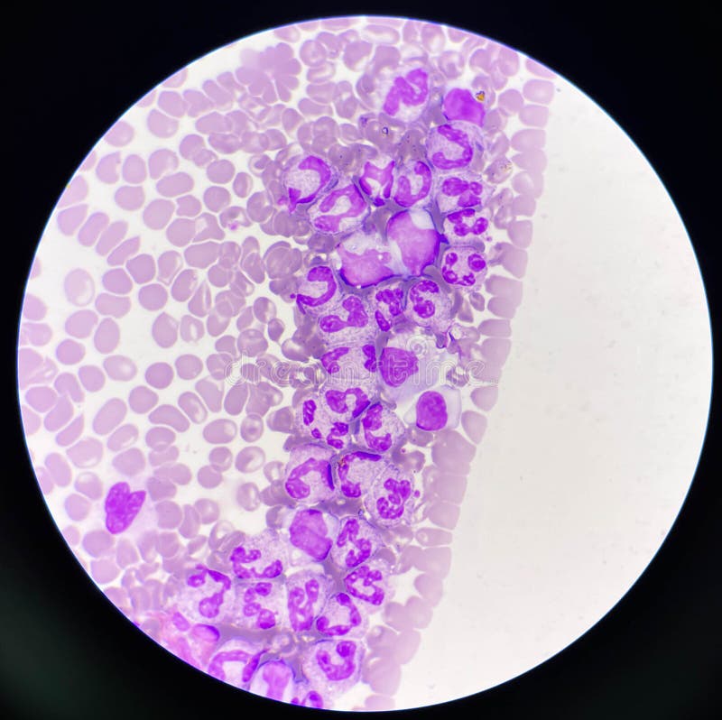 Moderate PMN in Septicemia Patient Stock Image - Image of artery ...
