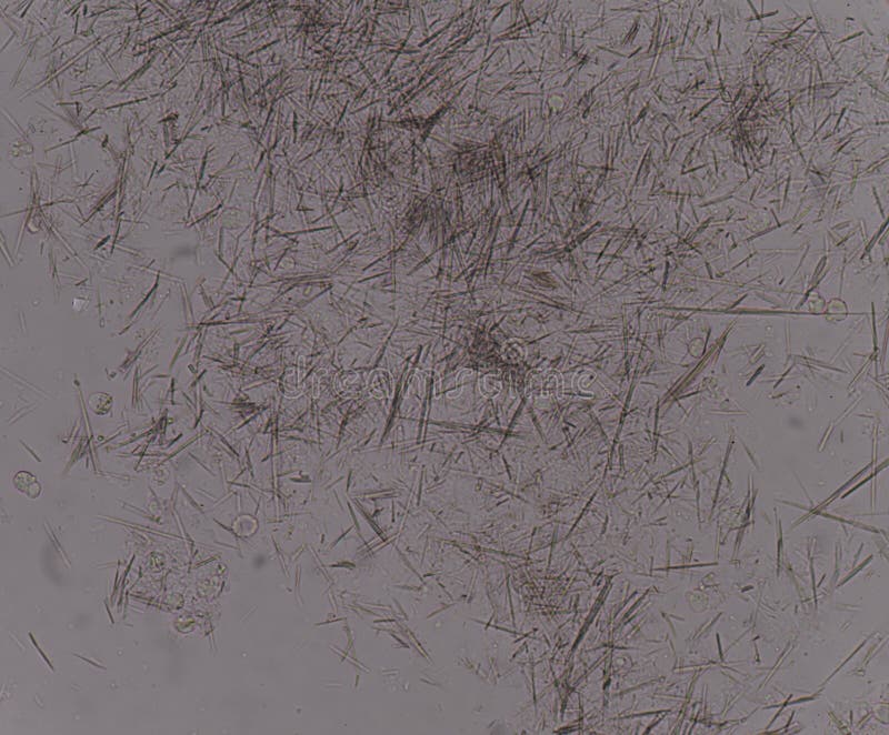 Moderate Uric Acid Crystal Needle Shape. Stock Image - Image of hand ...