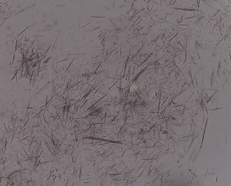 Moderate Uric Acid Crystals in Urine Stock Photo - Image of hospital ...