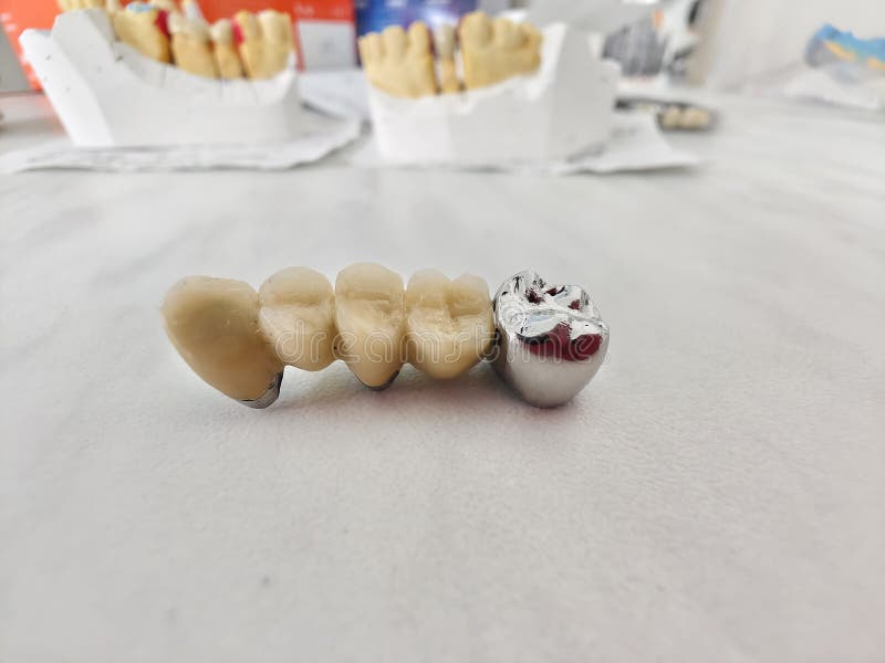 Modern Ceramic-metal Dental Bridge for Restoring Dentition Stock Photo ...
