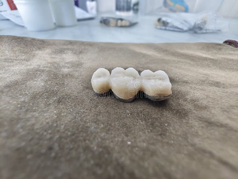 Modern Ceramic-metal Dental Bridge for Restoring Dentition Stock Photo ...