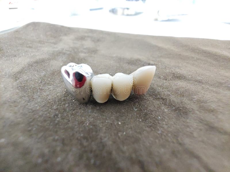 Modern Ceramic-metal Dental Bridge for Restoring Dentition Stock Photo ...