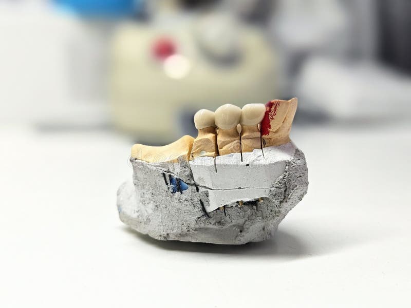 Modern Ceramic-metal Dental Bridge for Restoring Dentition Stock Photo ...