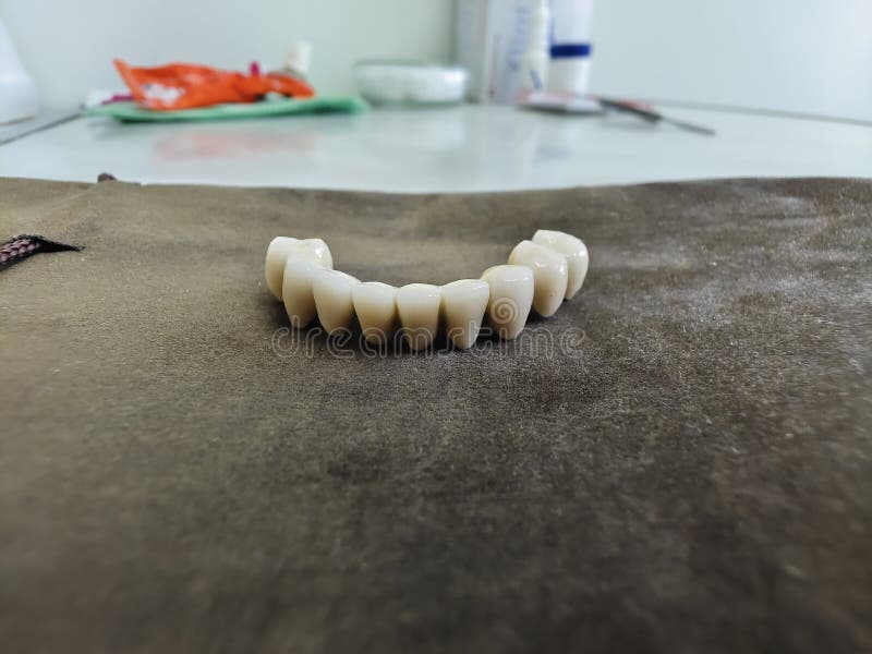 Modern Ceramic-metal Dental Bridge for Restoring Dentition Stock Image ...