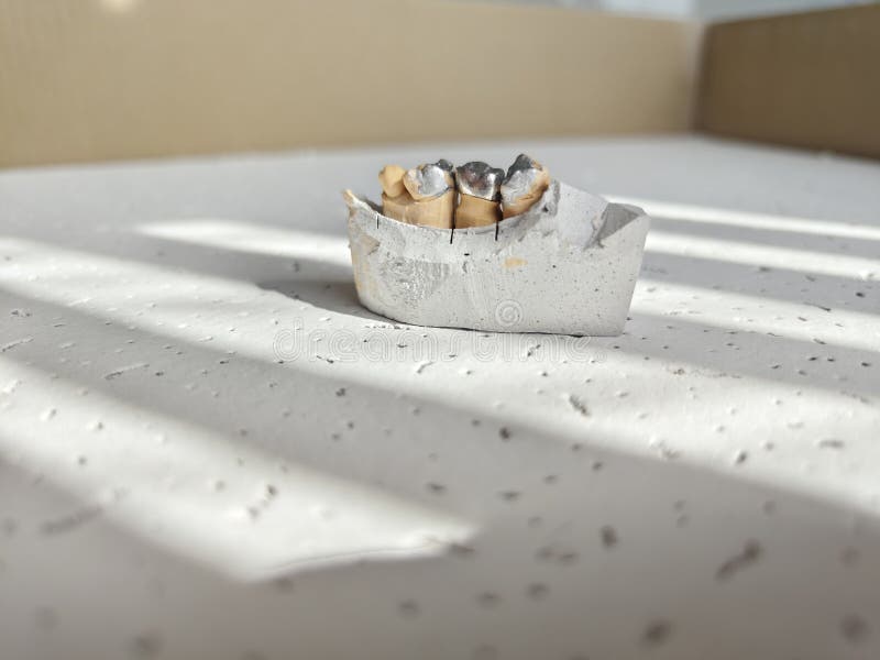 Modern Ceramic-metal Dental Bridge for Restoring Dentition Stock Image ...